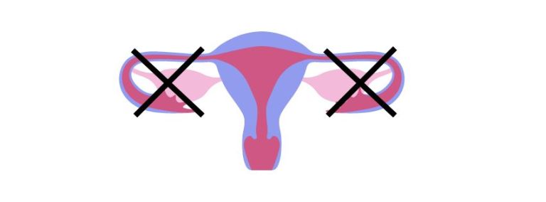 Types of Surgery – Surgical Menopause New Zealand Trust